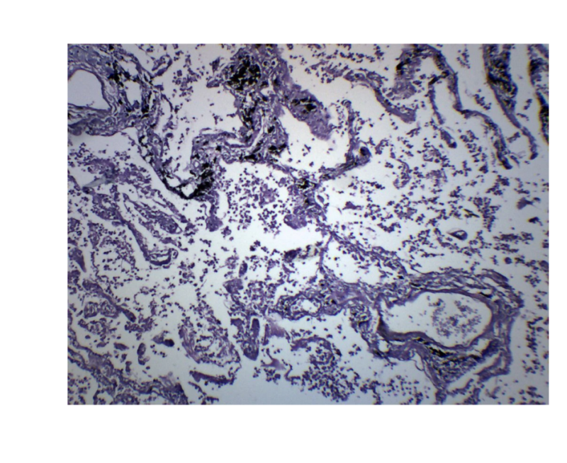 Pneumonia in Human Lungs – Prepared Microscope Slide – 75x25mm (EACH ...